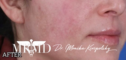 Patient #619 Acne Scarring Before and After Photos Beverly Hills, CA ...