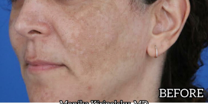 Patient #651 Melasma Before and After Photos Beverly Hills, CA ...