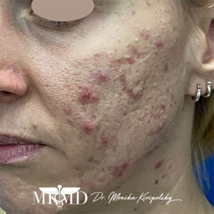 Patient #779 Acne Scarring Before and After Photos Beverly Hills, CA ...