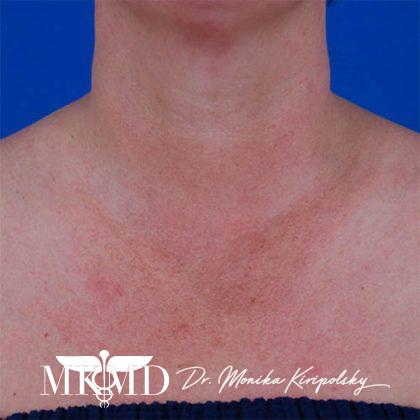 Patient #796 Diffuse Redness Before and After Photos Beverly Hills, CA ...